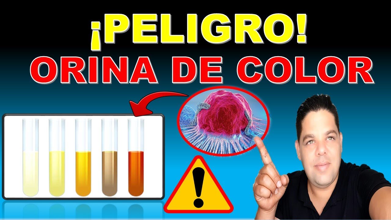 CÓMO INTERPRETAR EL COLOR DE LA ORINA: Causas Y Enfermedades Asociadas ...