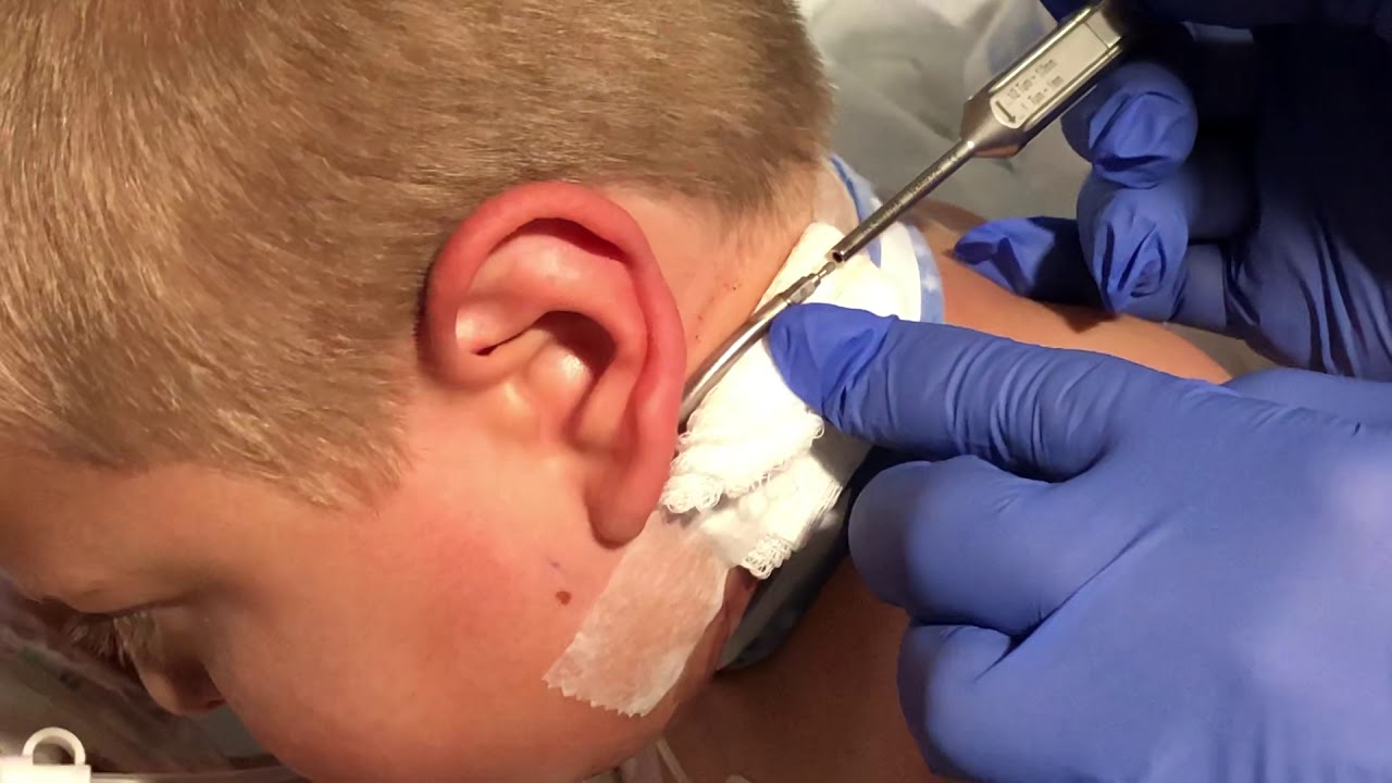 Jaw Distraction Adjustment on 5yr Old Male - YouTube