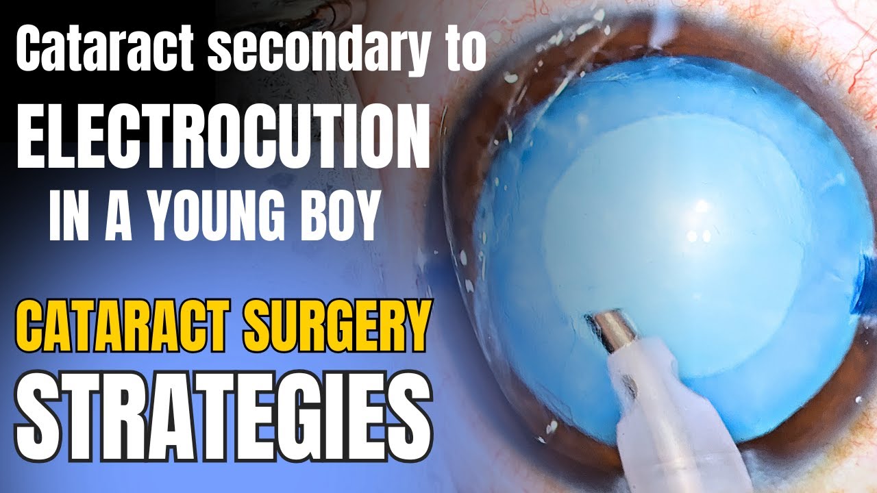 Cataract secondary to Electrocution in a young boy. Cataract Surgery ...