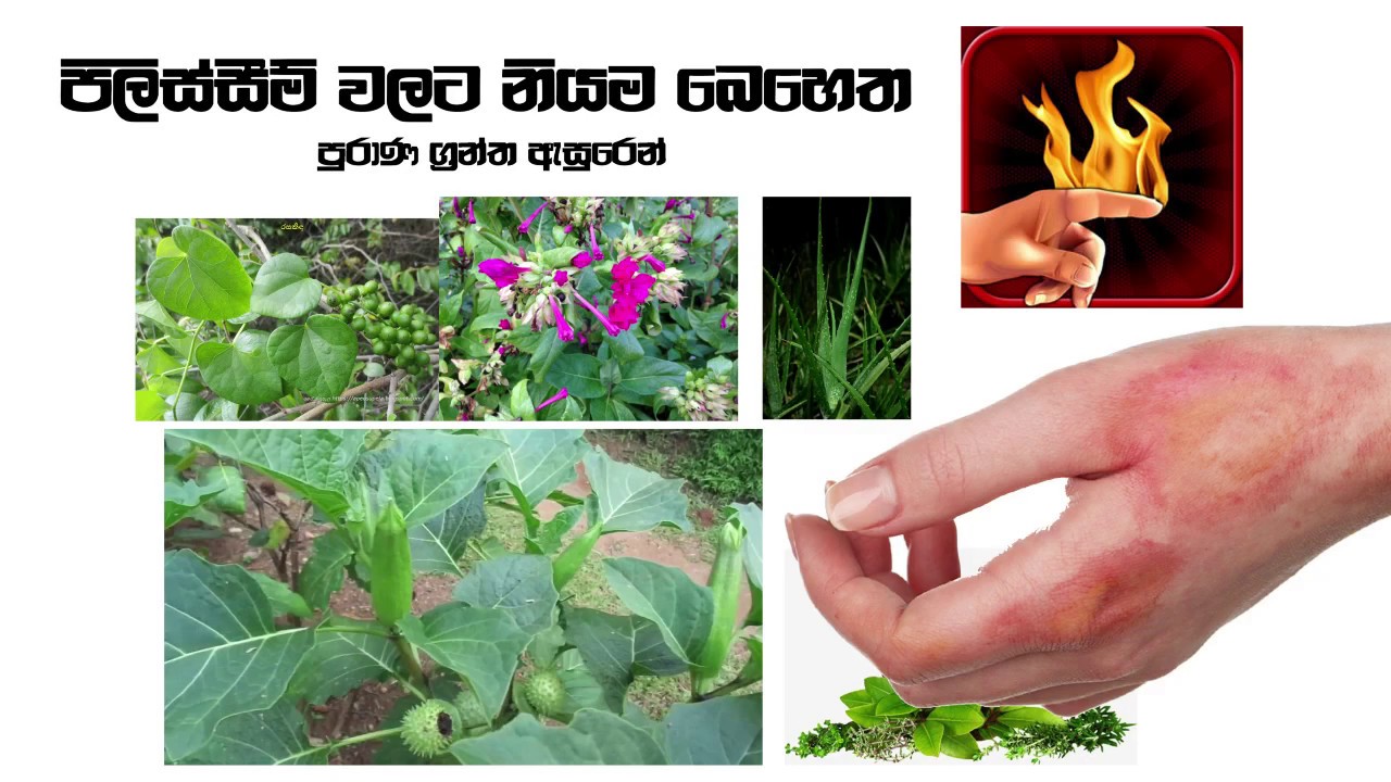 පිළිස්සුම් තුවාල සදහා නියම බෙහෙතක් - pilissum thuwala walata behath ...