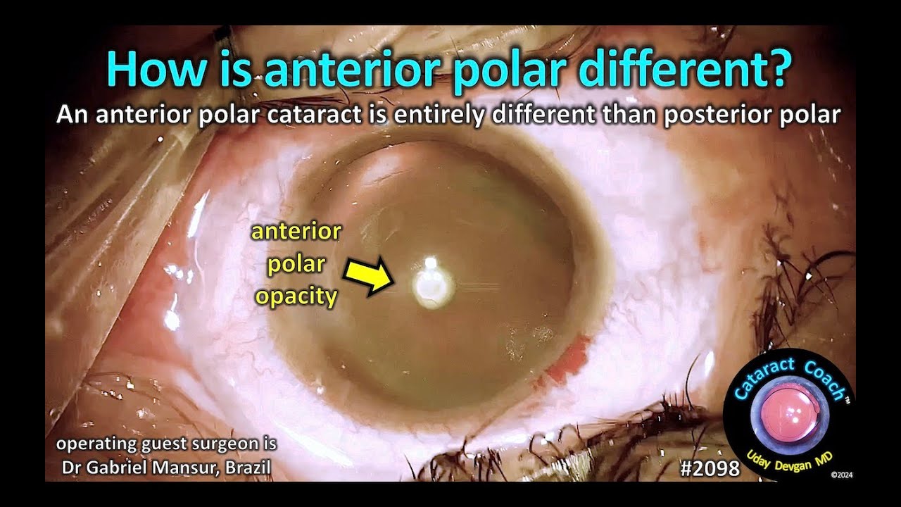 CataractCoach 2098 How Is Anterior Polar Cataract Different YouTube cataractcoach-2098-how-is-anterior-polar-cataract-different-youtube