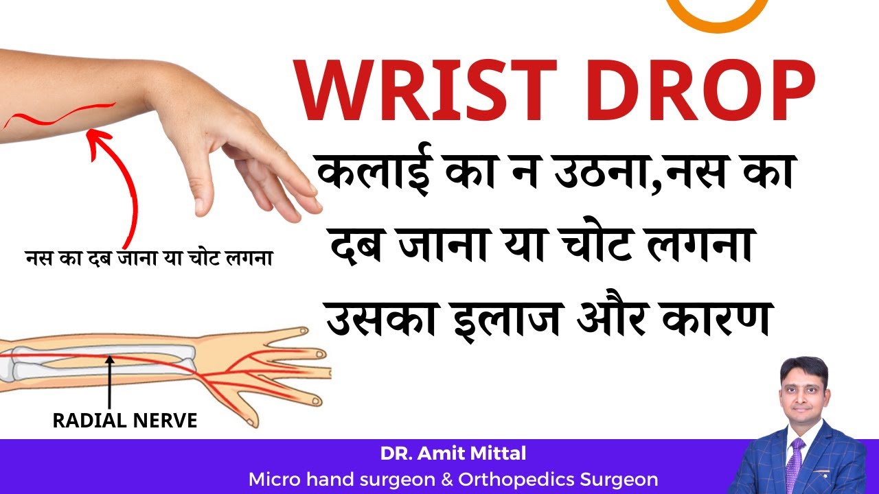 WRIST DROP क्या है? क्यों होता है ? इसका इलाज क्या है ? | Radial Nerve ...