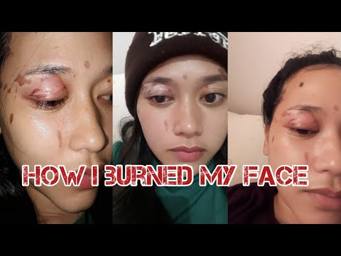 MY STORY ON HOW I BURNED MY FACE ( cooking oil 2nd Degree Burn ) - YouTube