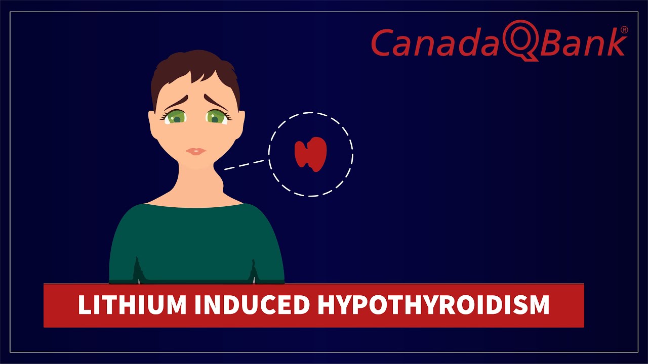 Lithium-Induced Hypothyroidism: Side Effects, Symptoms & Clinical ...