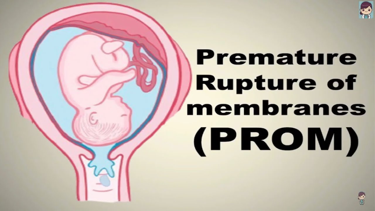 PROM || Difference between PROM & PPROM || Sign & Symptoms ...