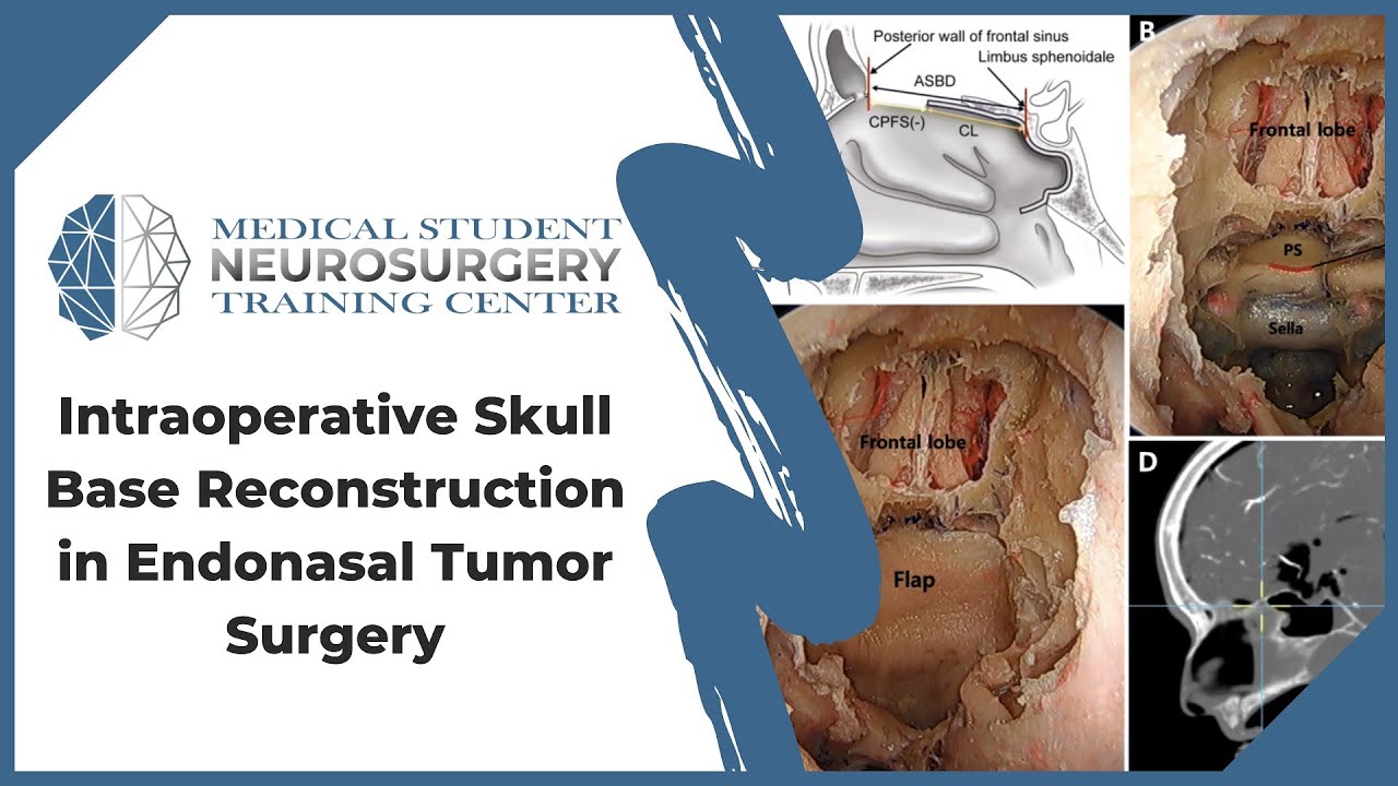 Intraoperative Skull Base Reconstruction in Endonasal Tumor Surgery ...