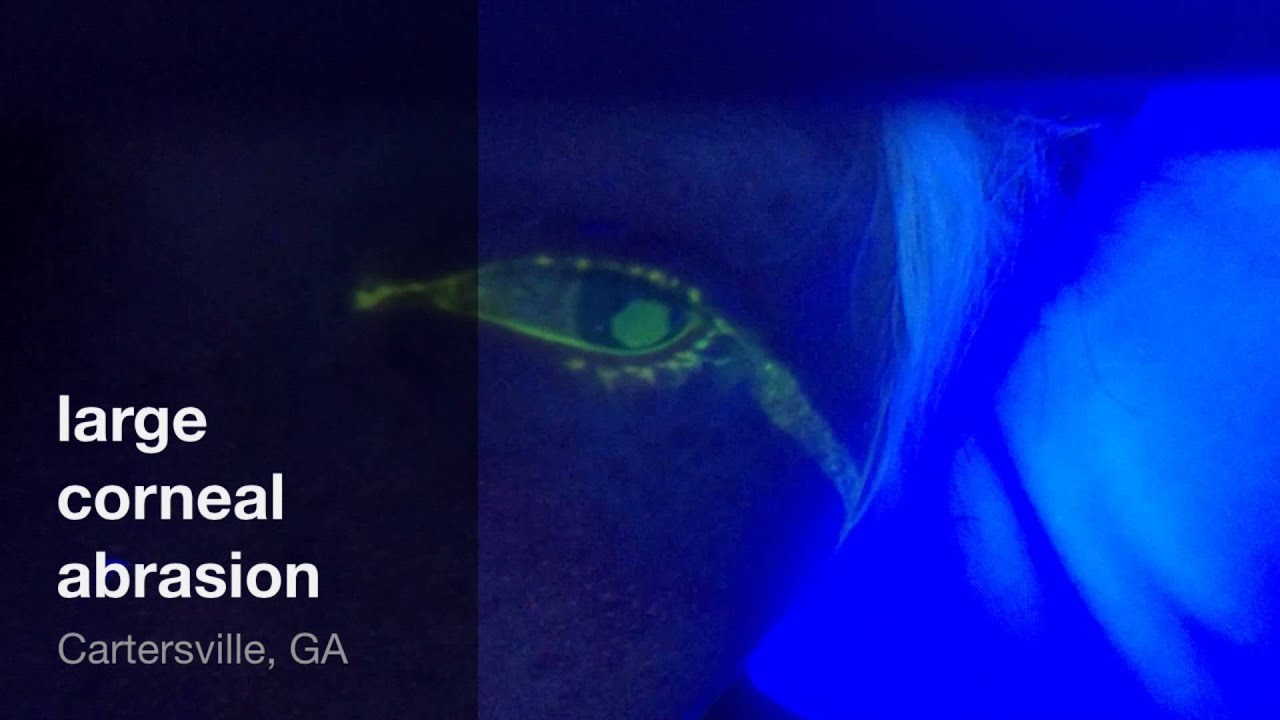 Severe Corneal Abrasion