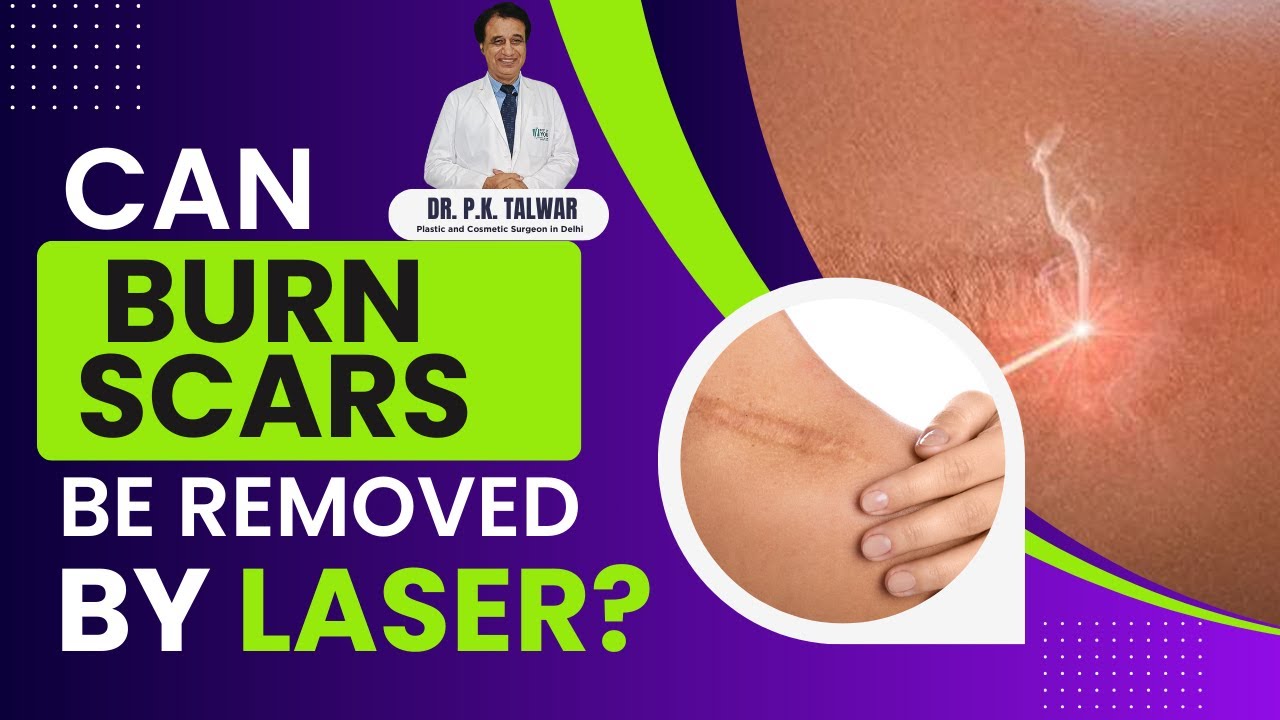 Can Burn Scars be Removed by Laser? Best Cosmetic Surgeon in Delhi | Dr ...