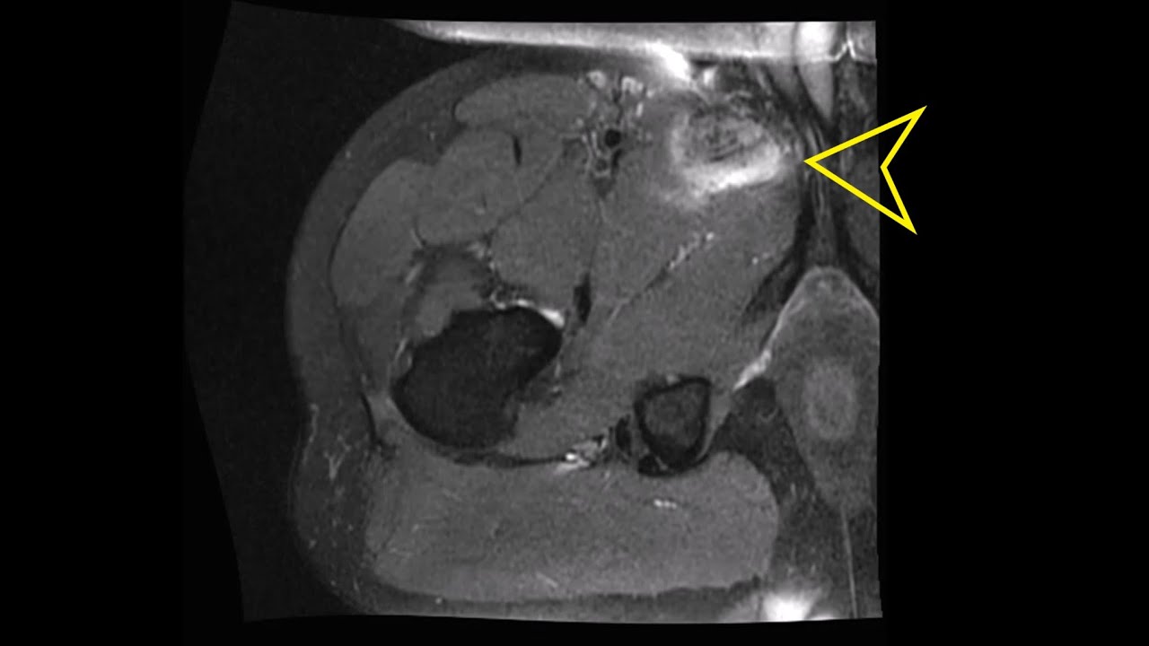 Thigh MRI: Adductor Longus Strain - YouTube