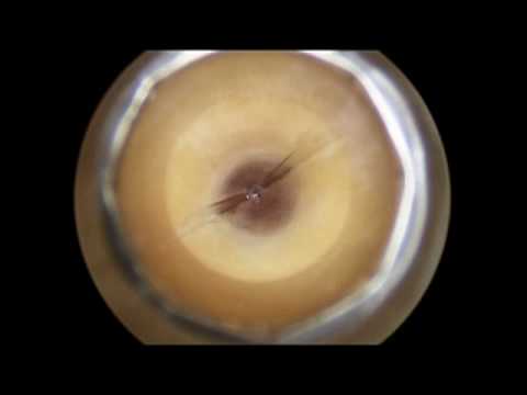 Direct Visual Insertion of a Laparoscopic Trochar - YouTube
