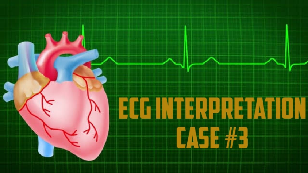 ECG interpretation case# 3 |LEAD REVERSAL ECG |EKG|Educational video ...