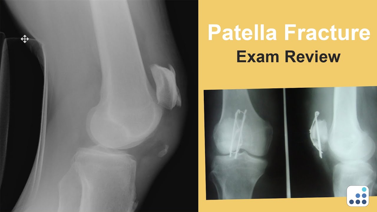 Patella Fracture Exam Review - C. Lowry Barnes, MD - YouTube