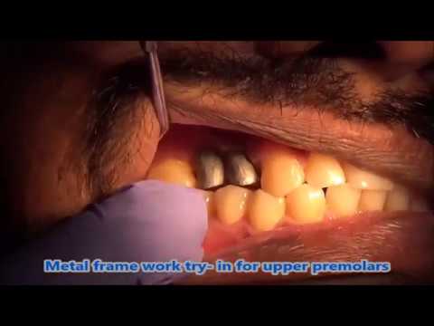 Metal framework try in for upper premolars with basal implants - YouTube