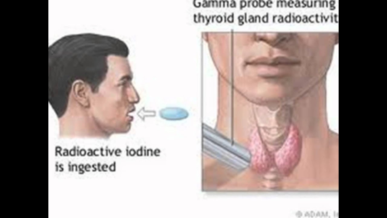 Iodine 131 YouTube iodine-131-youtube