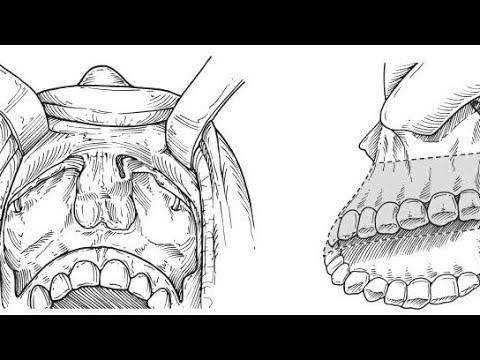 Juvenile Nasopharyngeal Angiofibroma (JNA) surgery at Aminu Kano ...