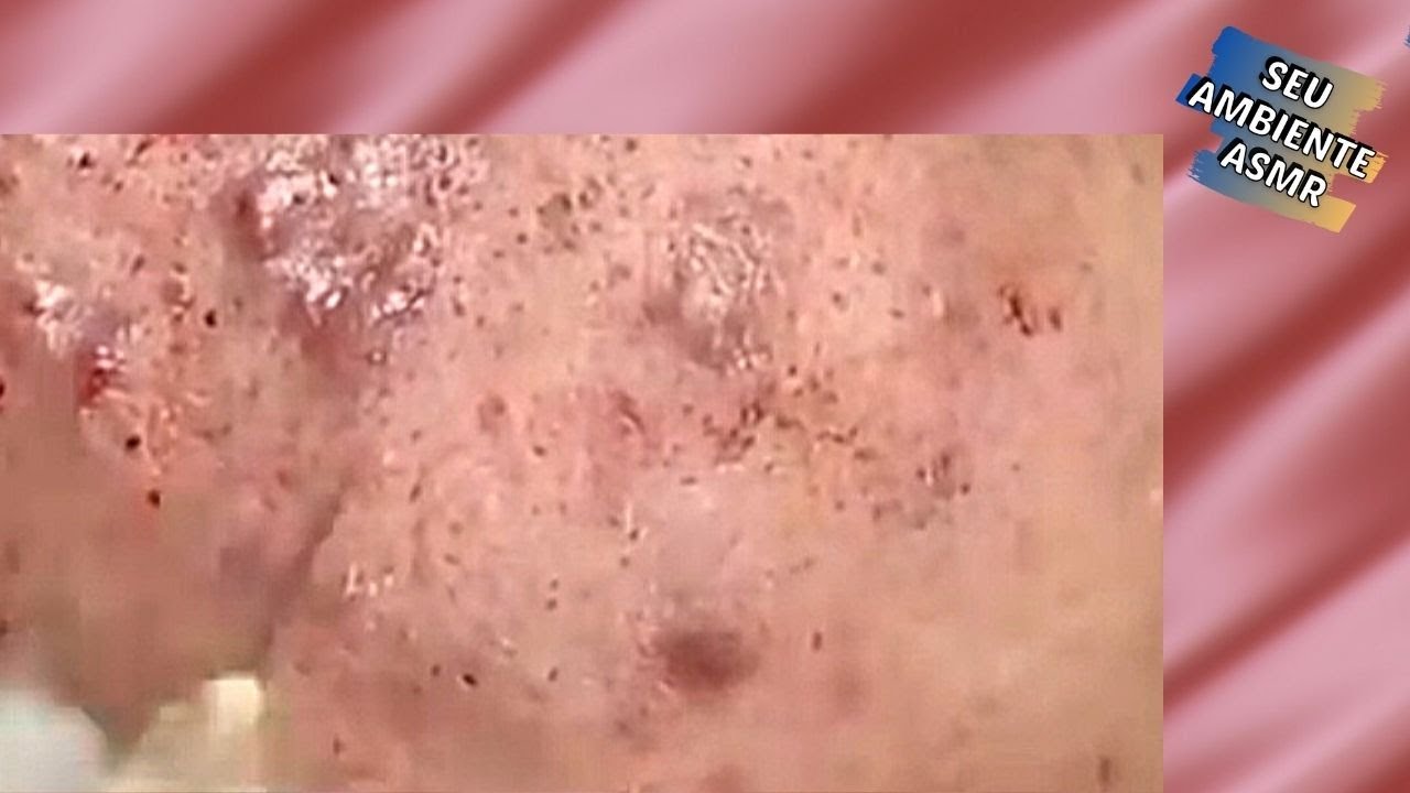 Retirando espinhas inflamadas no Rosto | Acne treatment | Vídeo ...