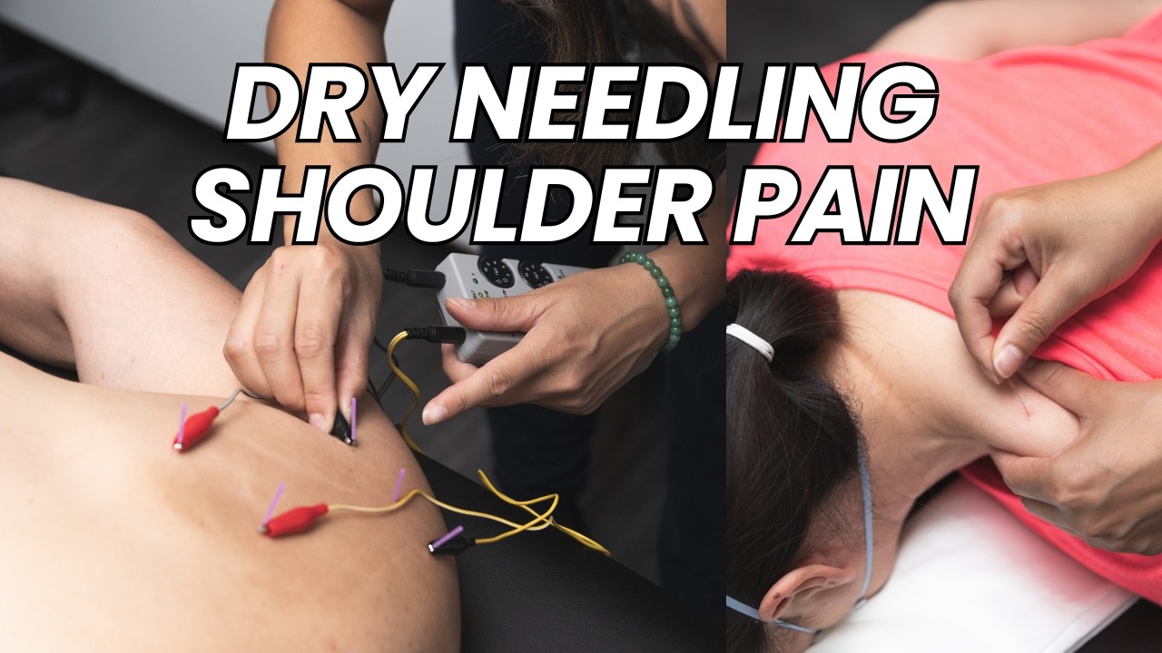 Dry Needling for Shoulder Pain - YouTube