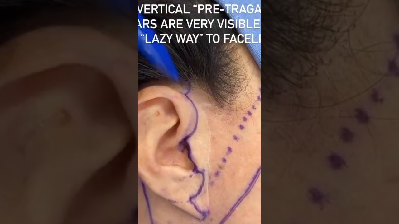 Revision Facelift: marking the incision line to hide the scar and ...