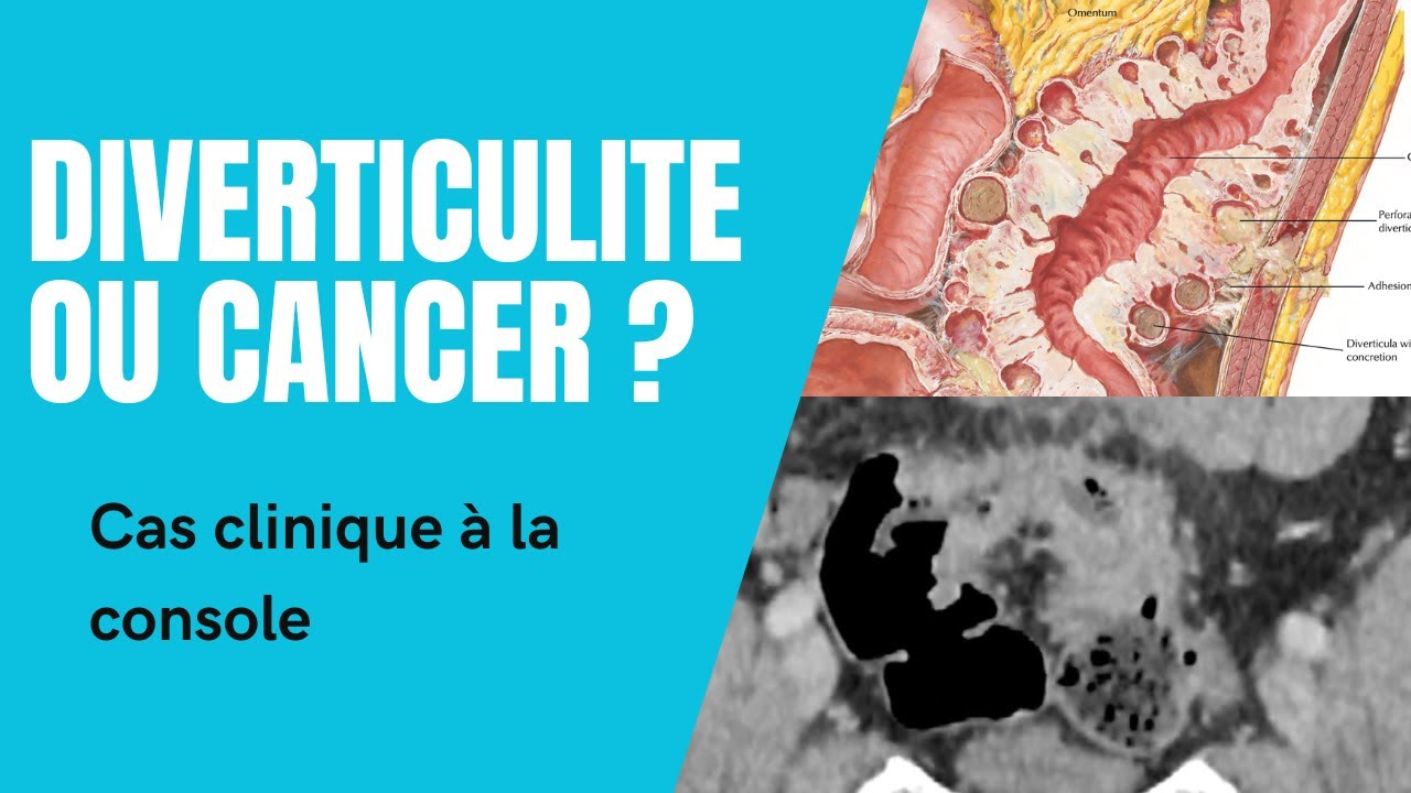 Diverticulite aigue sigmoïdienne ou cancer? Cas clinique à la console ...