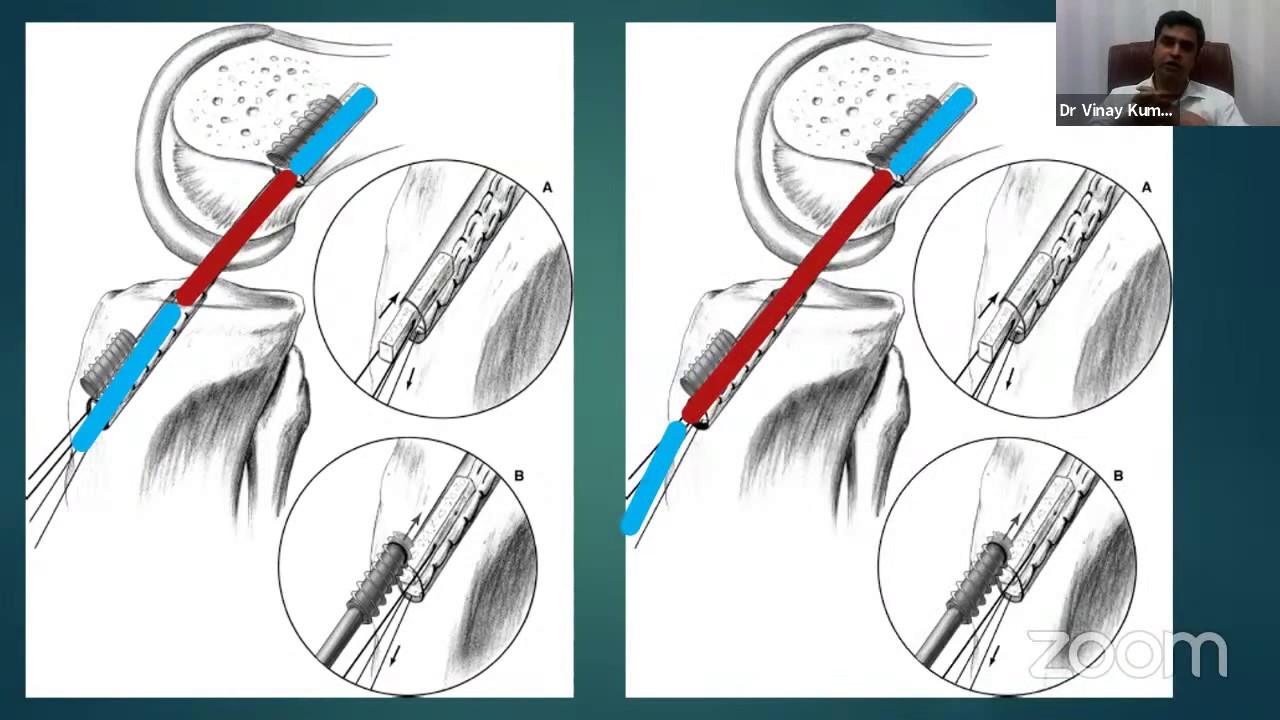 Complications of ACL Reconstruction | Dr Vinay K | Dr Francisco | Dr ...