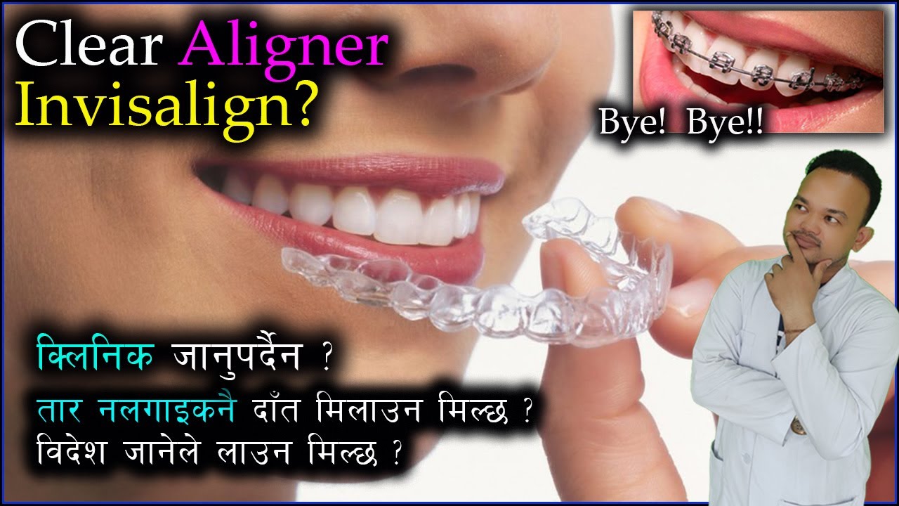 What is Clear Aligner/ Invisalign?/Gap banda kasari garne/Midline ...