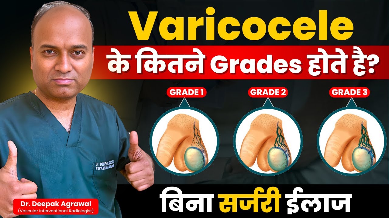 Varicocele Grade 1, 2, 3 Explained | Treatment कब ज़रूरी? Surgery vs ...
