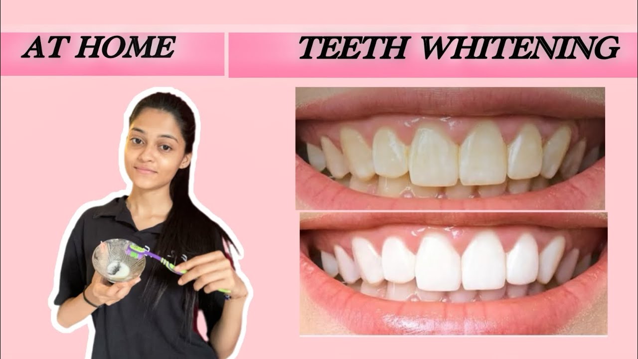 DIY Teeth Whitening at home🤍 - YouTube