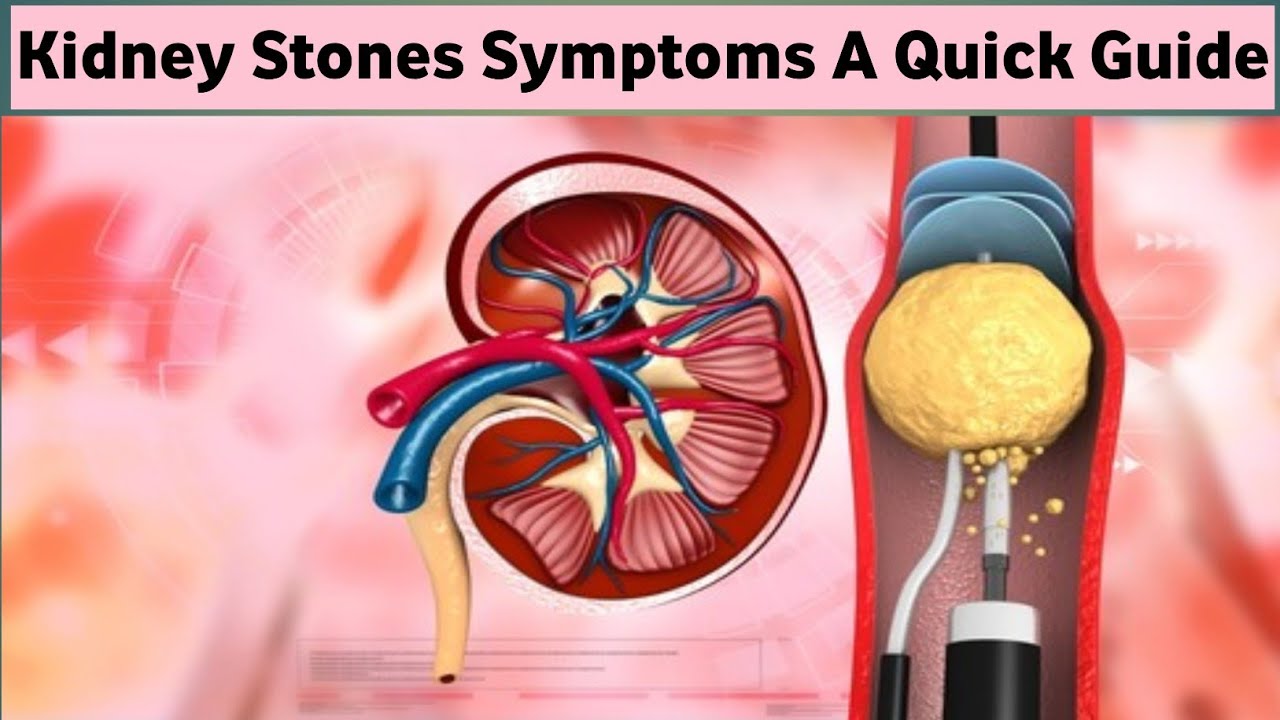 Kidney Stone Symptoms A Quick Guide - YouTube