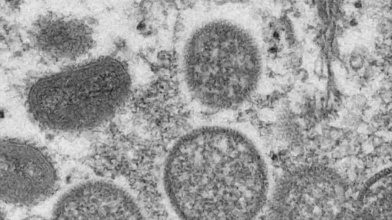 As monkeypox cases rise, Cleveland Department of Public Health to hold ...