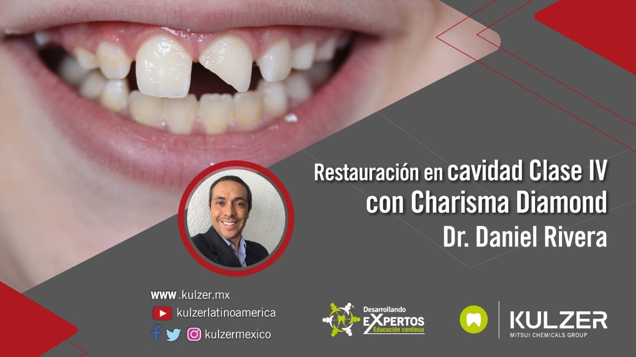 Desarrollando eXpertos - Restauración en cavidad clase IV con resina ...