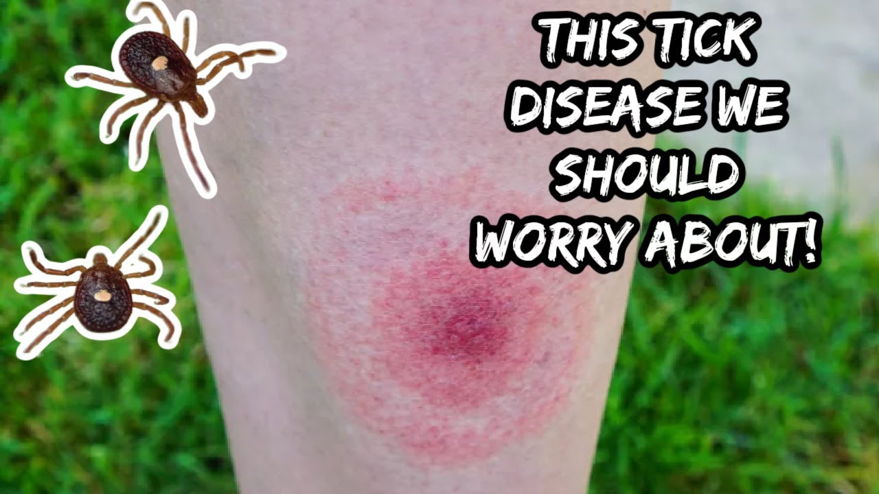 The TICK Disease we Should WORRY About! - YouTube