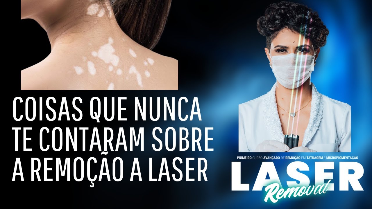 O QUE NÃO TE CONTARAM SOBRE REMOÇÃO A LASER. ACROMIA - YouTube