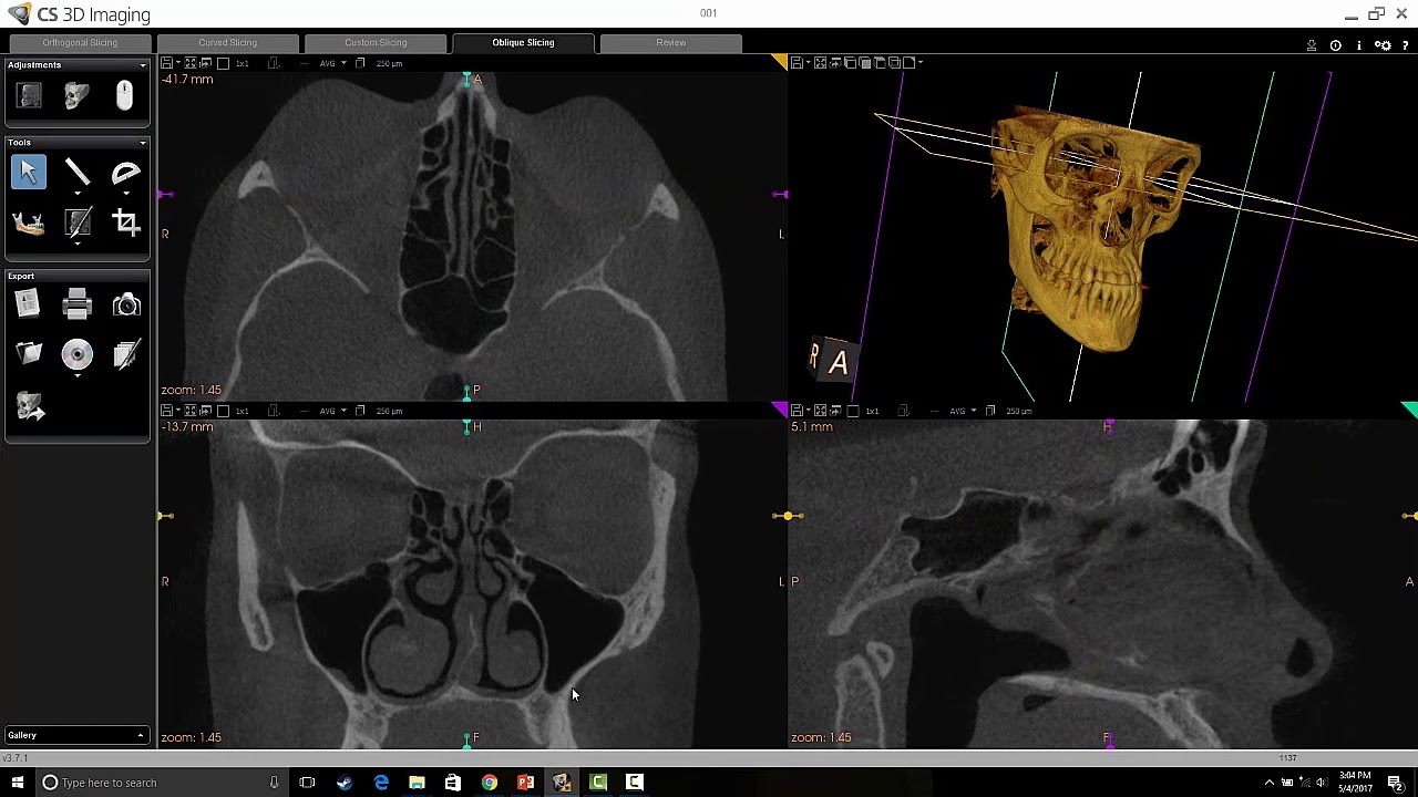 Carestream 3D Imaging - Full Skull Overview Dr. Steven Singer, Rutgers ...