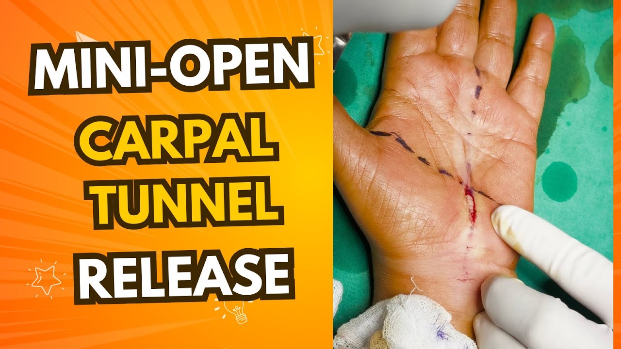 Mini-Open Carpal Tunnel Release – Simple & Effective Surgical Technique ...