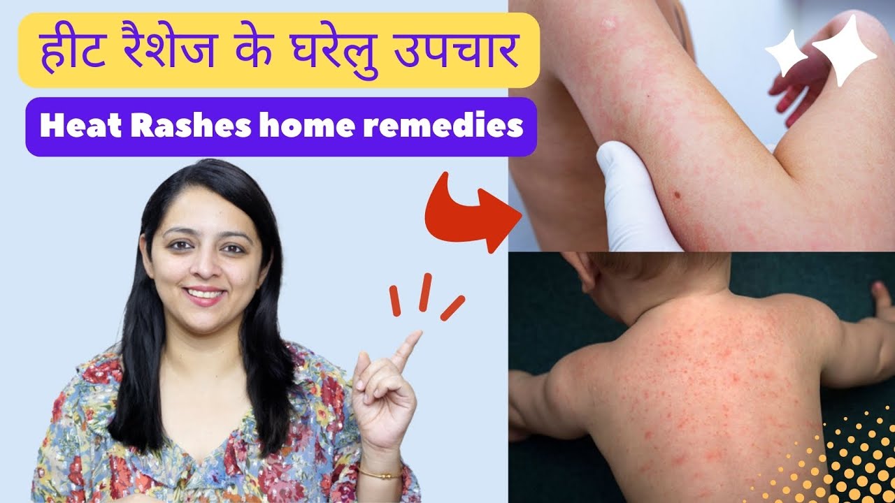 गर्मी में चुभती घमौरियों और हीट रैशेज के घरेलु उपचार | Heat Rashes home ...