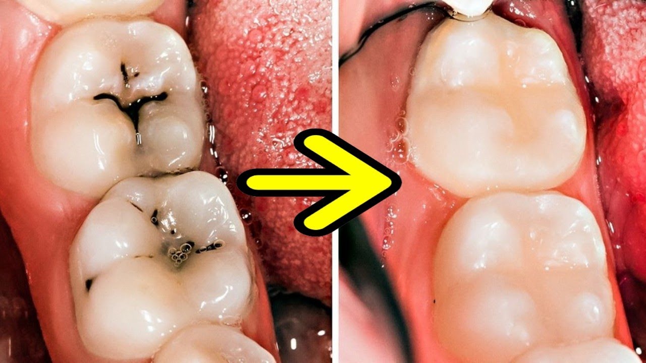 How to Cure Tooth Cavities Naturally | Treatment for a Tooth Cavity ...