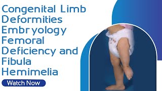 Congenital Limb Deficiency