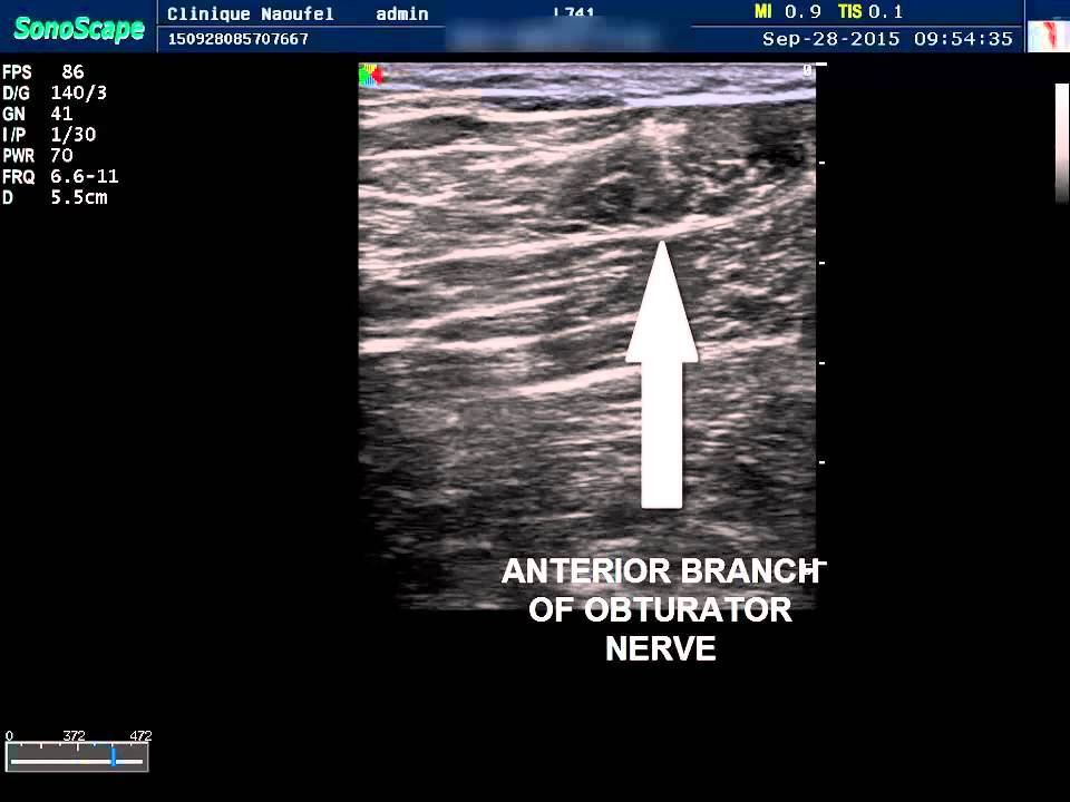 Obturatorius Reflex Neuropathie: Femoralis Neuropathie