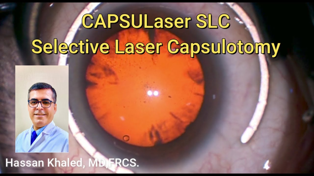 CAPSULaser SLC Selective Laser Capsulotomy - YouTube