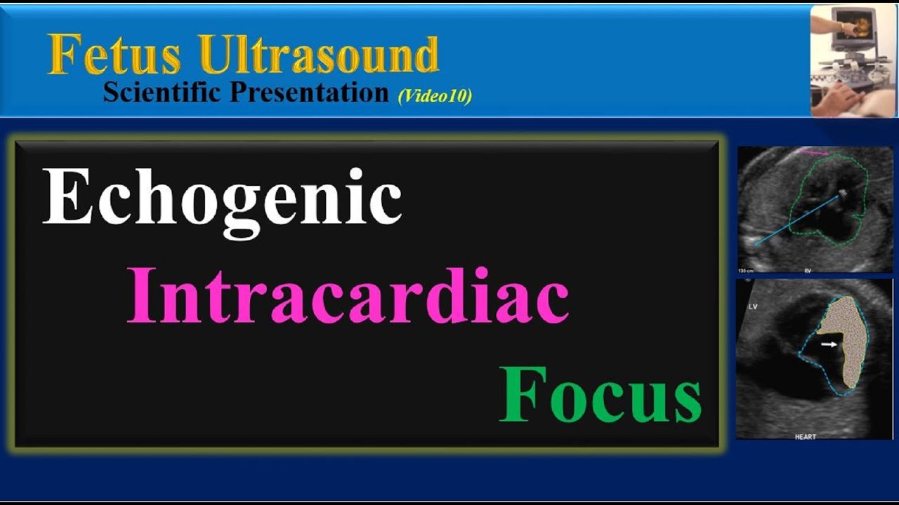 Fetus Ultrasound Echogenic Intracardiac Focus YouTube