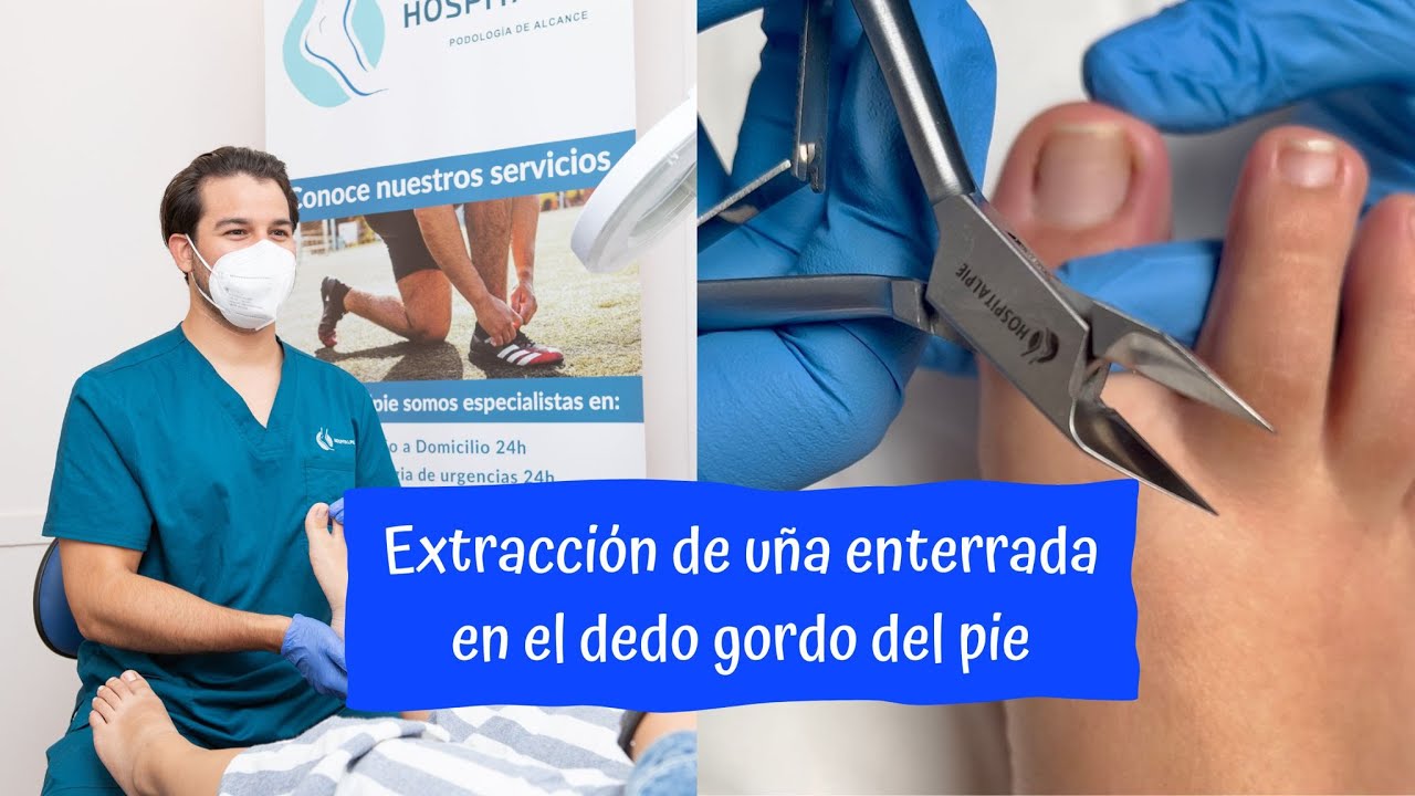 Como se extrae una uña enterrada sin anestesia - YouTube