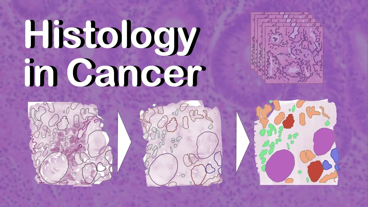 Histology in Cancer - YouTube