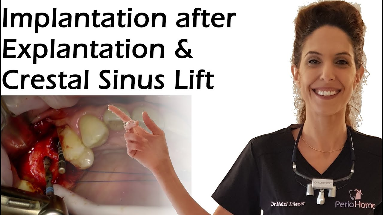 Implantation After Explantation & Crestal Sinus Lift - YouTube