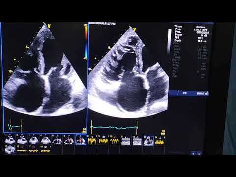 RV non-compaction - YouTube