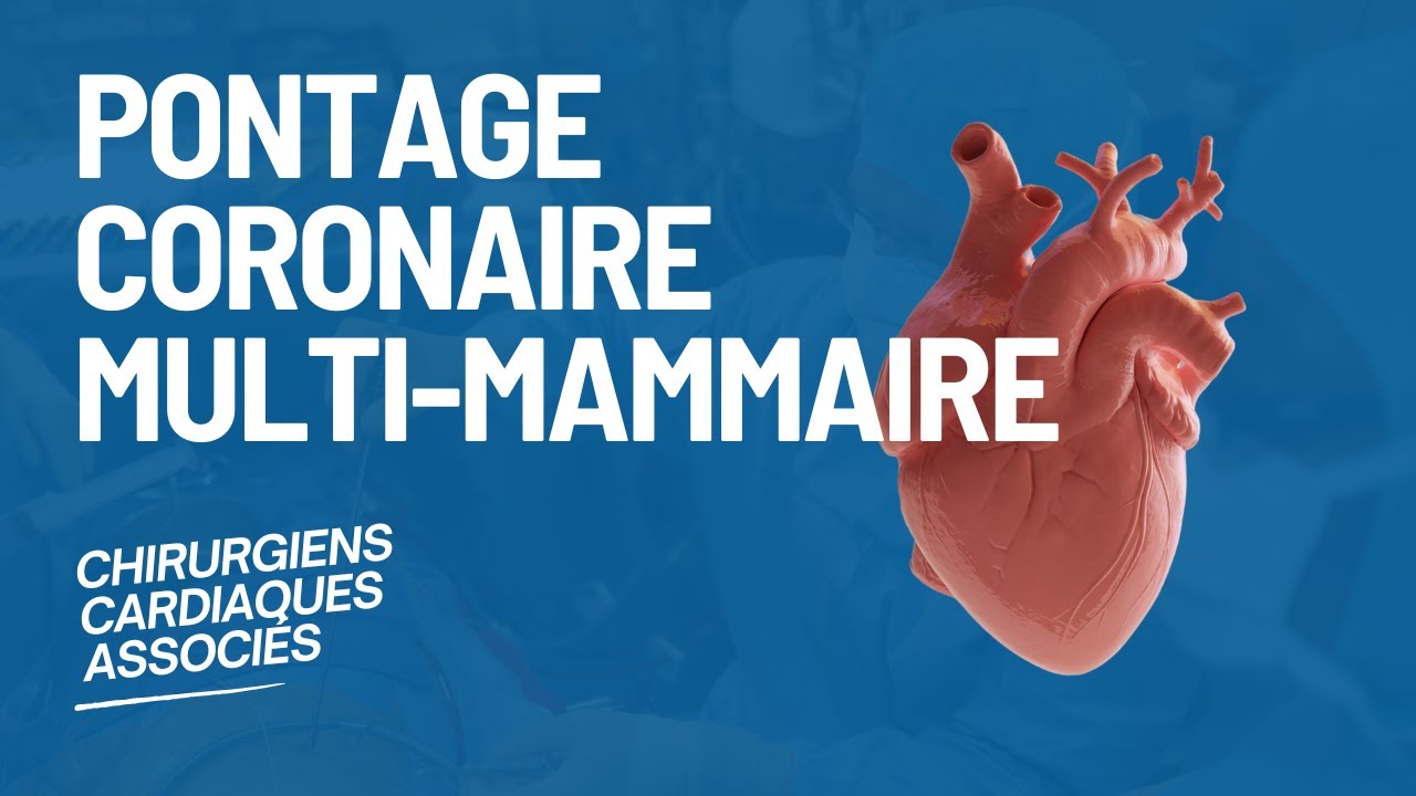 Pontage coronaire multi-mammaire - YouTube