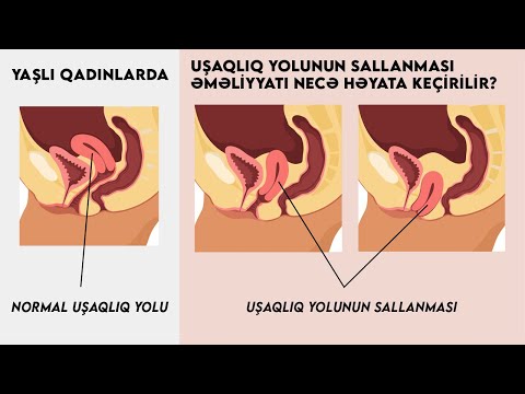 Yaşlı qadınlarda uşaqlıq yolunun sallanması əməliyyatı necə həyata keçirilir? ( Aytən Nəcəfəliyeva )