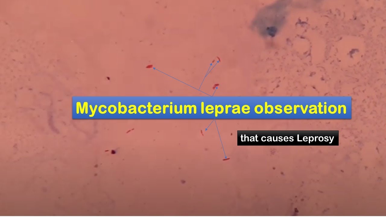 Mycobacterium leprae in Ziehl-Neelsen stained slit skin smear - YouTube