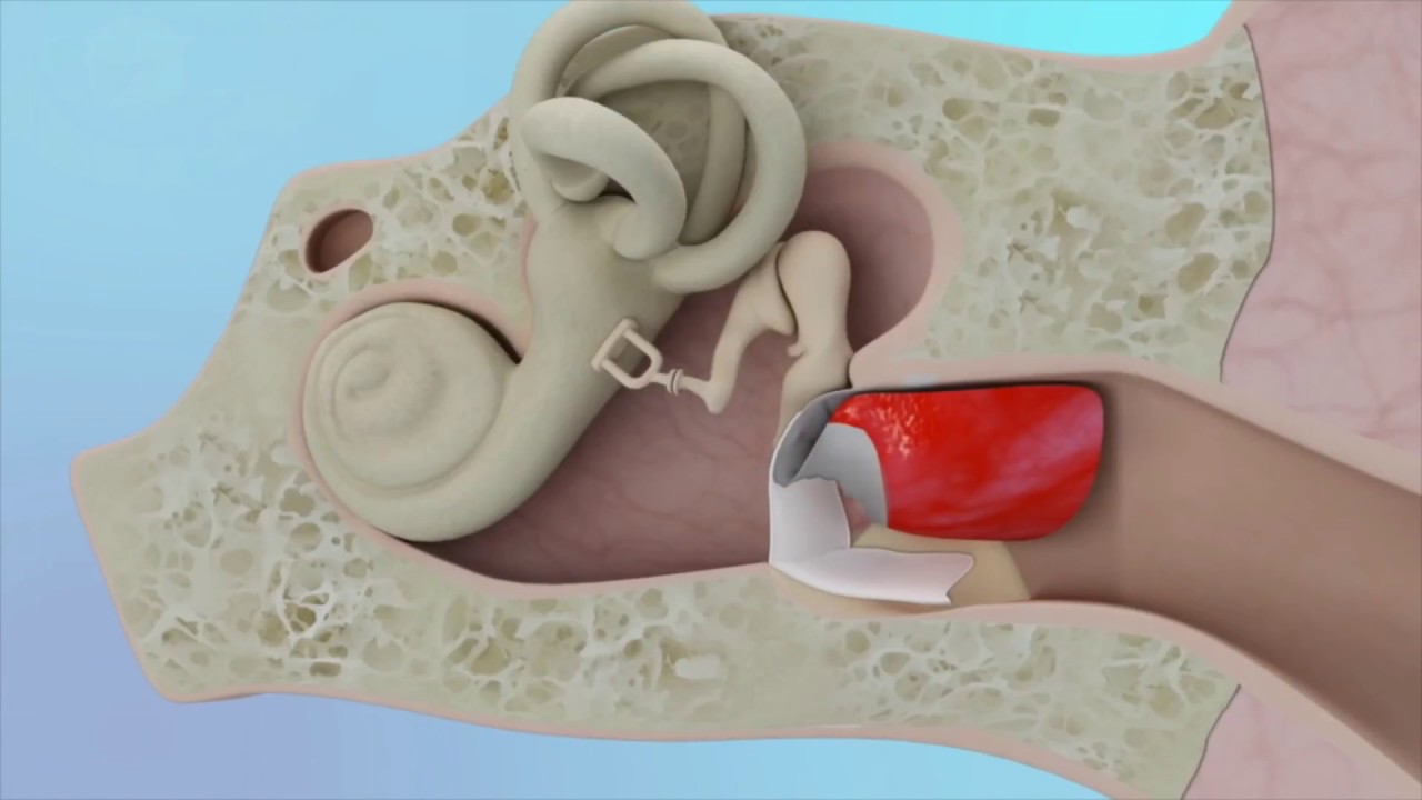 Batra Hospital Dr Sanjay Jain Microscopic Ear Surgery - YouTube