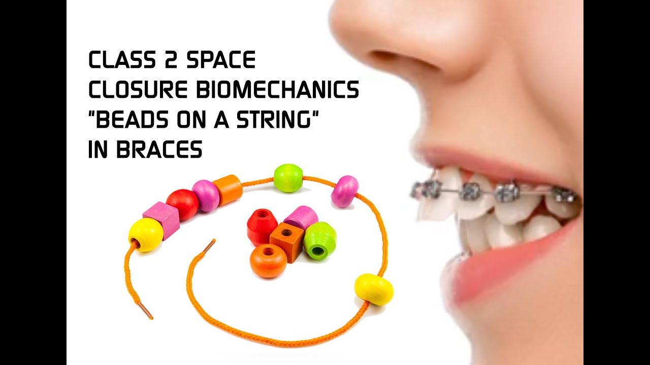 Biomechanics for a Class 2, Class II Extraction Space Closure- "beads ...
