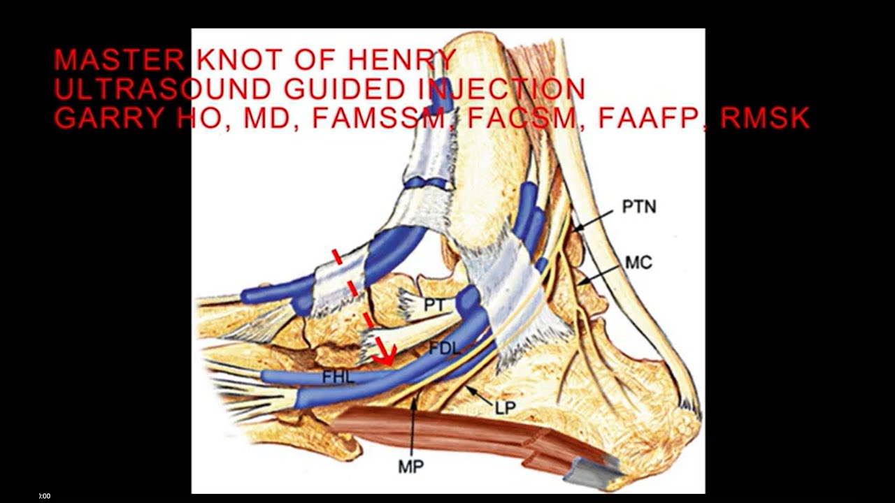 ULtrasound-Guided Injection at the Knot of Henry - YouTube